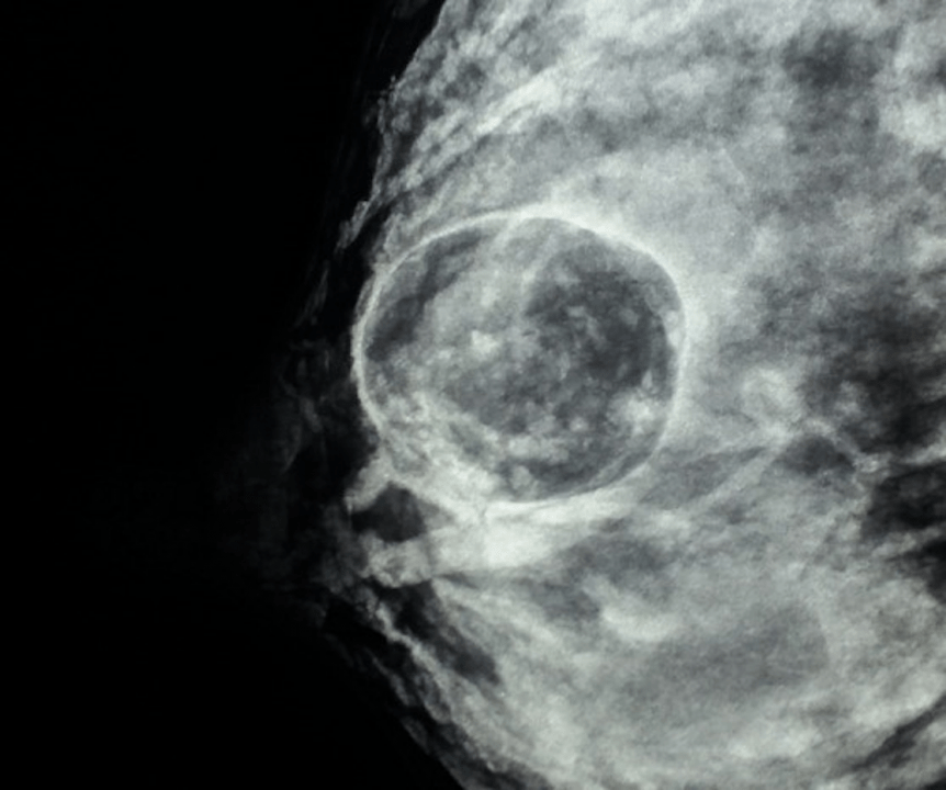 Diagnóstico por imagem: Galactocele – Relato de caso | Newslab