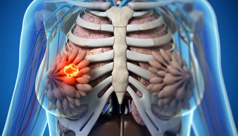 Saiba como o câncer de mama resiste à quimioterapia | Newslab