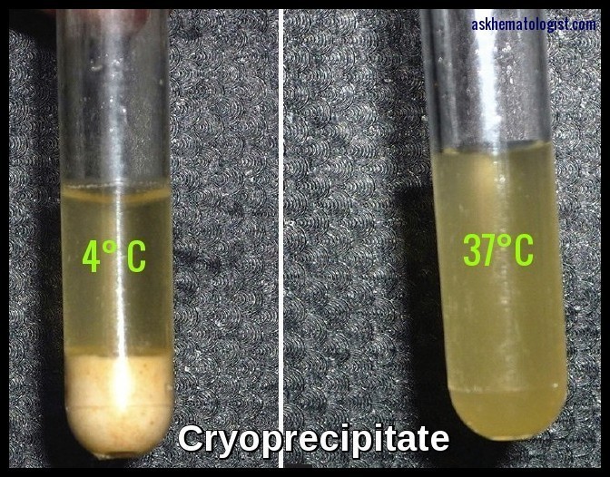 Artigo II Ed. 165 | Crioglobulinemia | Newslab