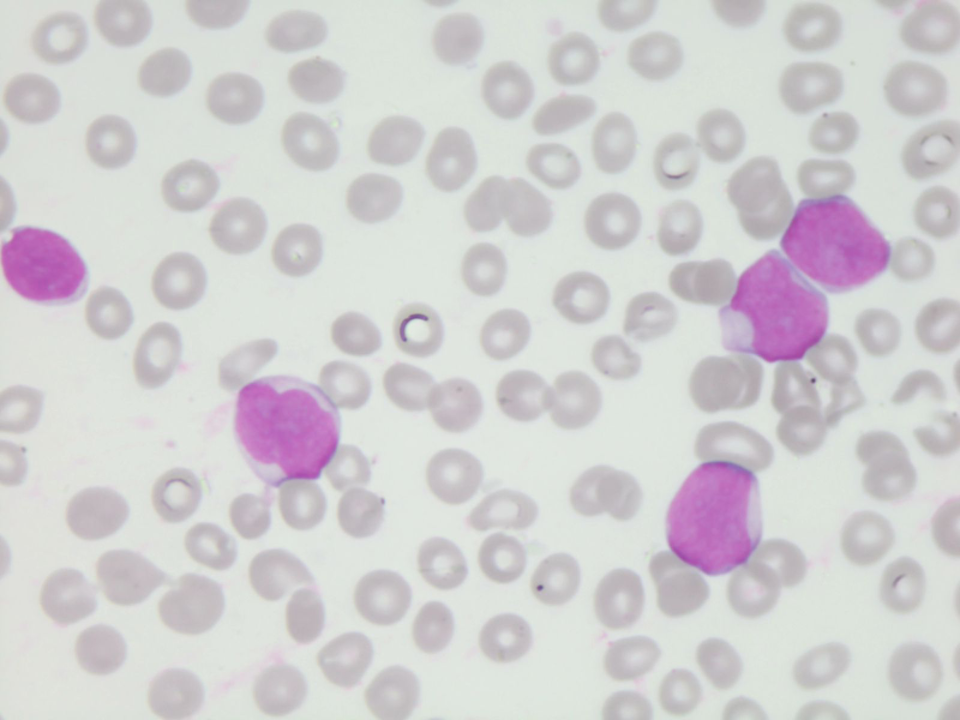 Como identificar blastos? | Newslab