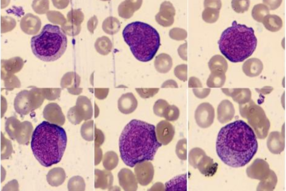 Como identificar blastos? | Newslab