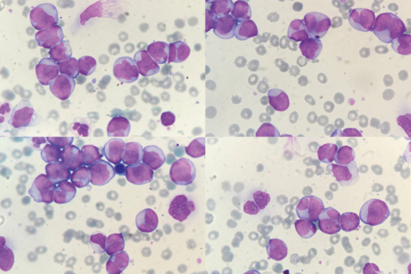 Como identificar blastos? | Newslab